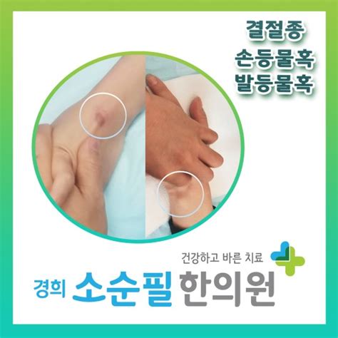 손등물혹 발등물혹 결절종