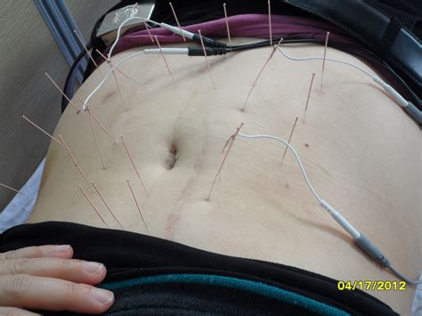 Weight Loss And Acupuncture Acupuncture And Nutrition Clinic Houston