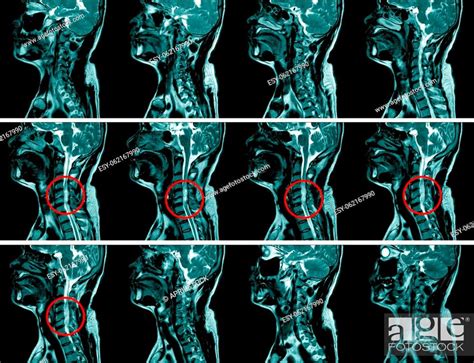 Mri C Spine Showing Mass At Left Posterolateral Aspect Of C4 5 Spinal