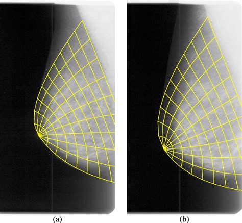Figure 1 From An Anatomically Oriented Breast Coordinate System For Mammogram Analysis