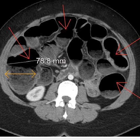 Axial Ct Scan Red Arrows Show Severe Distention Of The Small And Large