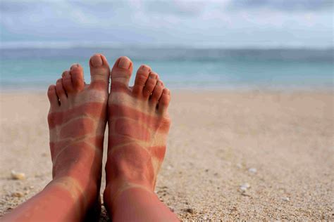 How Long Does Sunburn Last From Redness To Recovery Credihealth