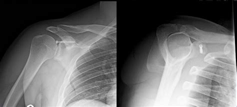 An Anteroposterior Ap And Scapular Y Radiograph Of A Right Shoulder