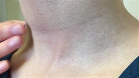 How To Do Scar Massage After Thyroid Surgery Youtube