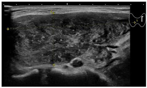 Close Up Of The Left Thyroid Lobe At The Time Of Initial Presentation