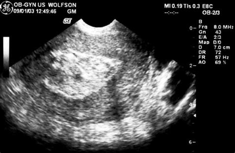 Uterine Cavity Ultrasound