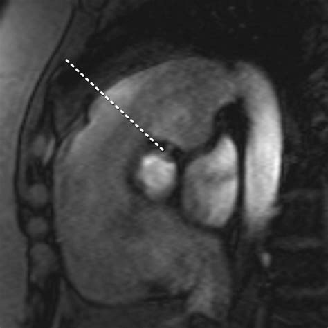 Cardiovascular Applications Of Phase Contrast Mri Ajr
