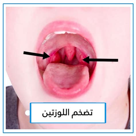 ‎dr Lara Bannout دكتورة أطفال‎ ‎انتقل إلى الصورة التالية👉🏻 عدوى