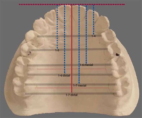 Maxillary Dental Arch Length Measurements Download Scientific Diagram