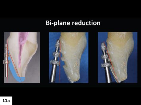 Veneer Preparation And Temporization Tips And Techniques