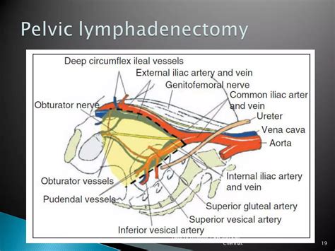 Prostate Carinoma Surgery Open Radical Retropubic Prostatectomy Rrp Pdf