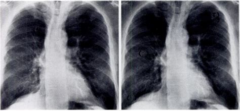 Chest Radiographs Without A And With B Computer Reported Results