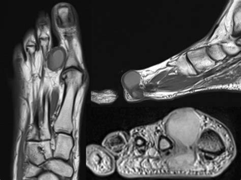 T1 Weighted Mri Imaging Of The Right Foot Download Scientific Diagram