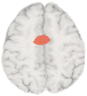 The Group Mean Activation In The Anterior Cingulate Cortex Following Download Scientific