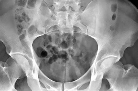 Doctors Remove 7 Inch Sex Toy From Mans Bladder