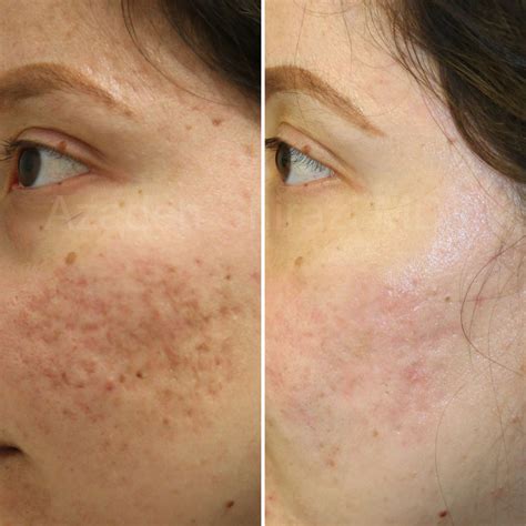 Considering Subcision For Acne Scars Read This First