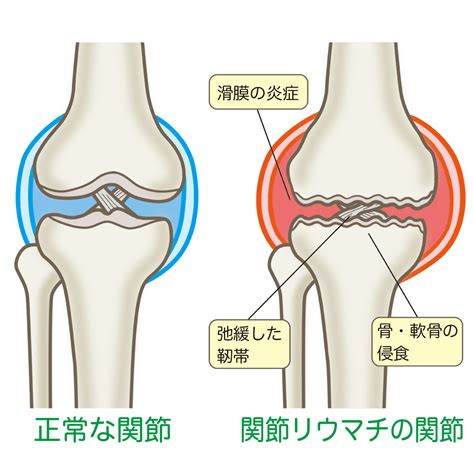 リウマチについて ひたち野ステーションクリニック