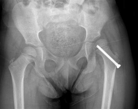 Ap X Ray Of Pelvis Demonstrating Proximal Femoral Guided Growth In Hip