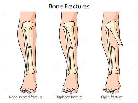 Types Of Bone Fractures Diagram Medical Science Stock Vector
