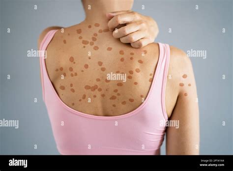 Itchy Back Causes No Rash At Harvey Horton Blog