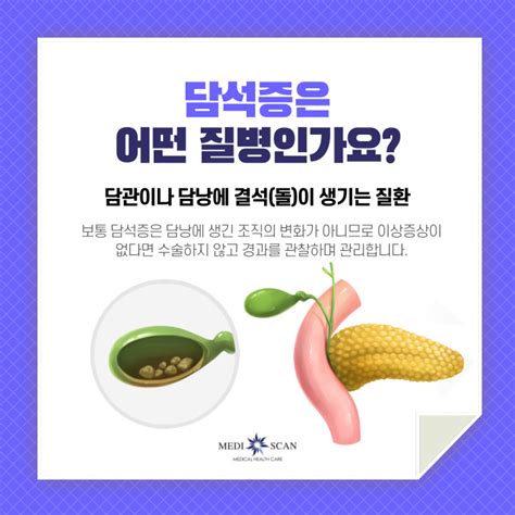 담석증 원인과 증상 건강검진으로 확인하세요 카드뉴스 고객센터 메디스캔의원