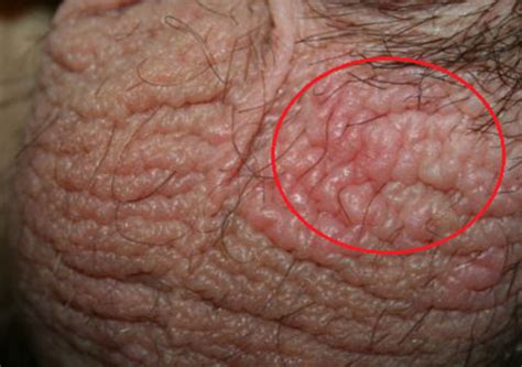 Scrotal Eczema Understanding Treating And Preventing This Common Yet