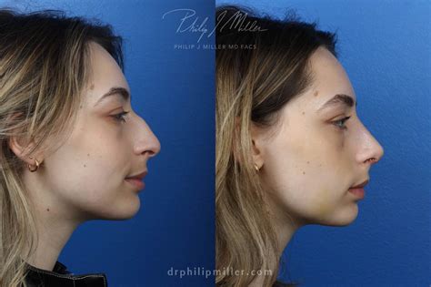Nose Taping After Rhinoplasty Philip Miller MD