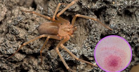 Araña Violinista Cómo Reconocerla Y Qué Hacer Si Te Pica