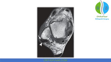 Peroneal Tendinopathy Orthofixar