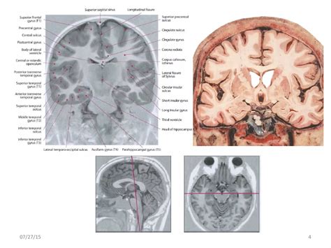 Anterior Temporal Lobectomy Ppt