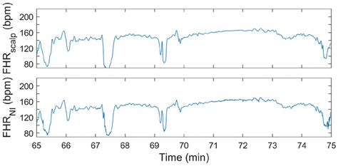 Fhr Tracing During Second Stage Of Labor In The Top Panel The Fhr