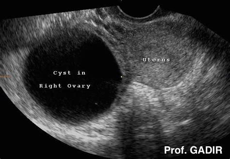Ovarian Cysts Artofit