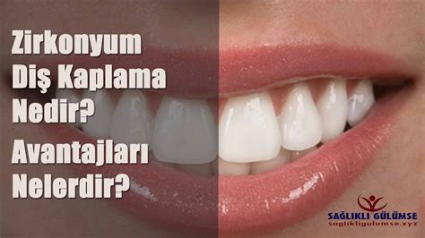 Sağlıklı Gülümse Zirkonyum Diş Kaplama