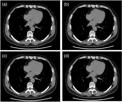 Image Quality Improvement In Low‐dose Chest Ct With Deep Learning Image Reconstruction Pmc