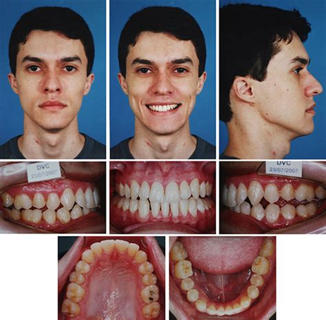 List 97 Pictures Underbite Surgery Before And After Pictures Updated