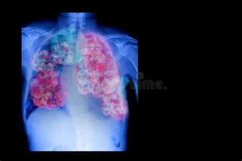 Chest X Ray Lung Cancer Images At Rosetta Prather Blog