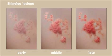 Shingles Prevention 5 Essential Tips Getfithive