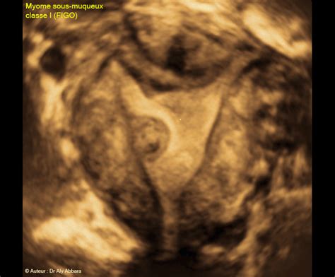 Myome Utérin Endocavitaire Sous Muqueux De Classe 1 Figo 2011 échographie