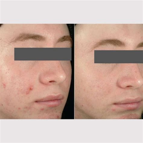 Skin Care Acne Gallery Dr Davin Lim