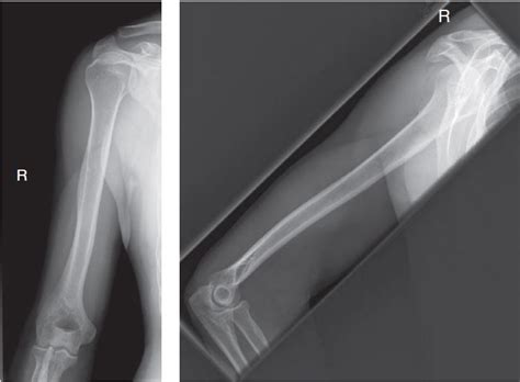 Lateral Humerus X Ray Age Affects Lateral Spurring After Pedia