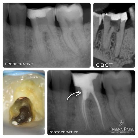 Kreena Patel On Linkedin Saveteeth Endodontics Endo Endodonticspecialty