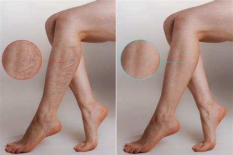 Scottsdale Liposuction Dr Hall Scottsdale