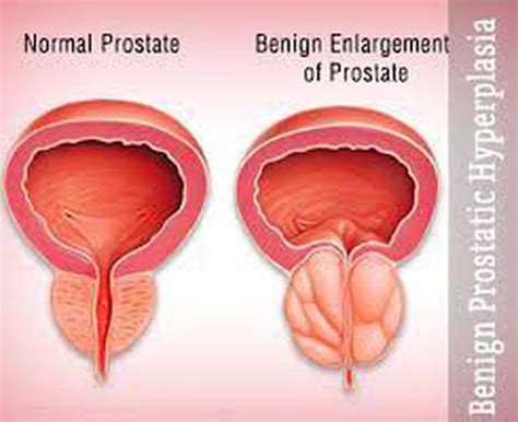 Causes Of Benign Prostatic Hyperplasia Medizzy