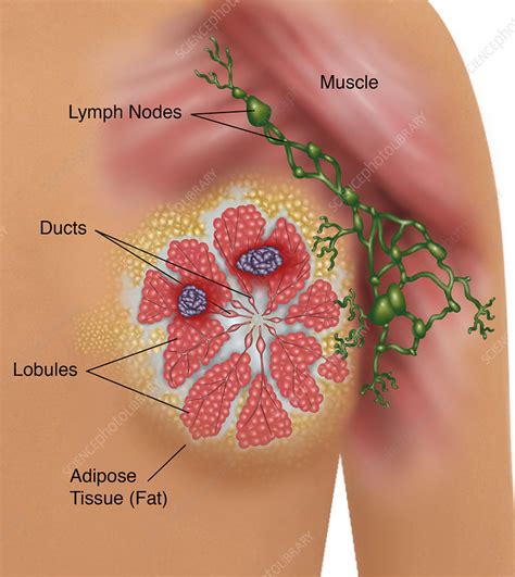 Breast Cancer Stock Image F031 6655 Science Photo Library