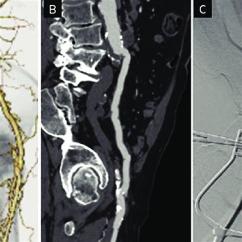 A Computed Tomography Angiography Shows A Patent Aorto Bifemoral Download Scientific Diagram