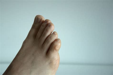 Whats The Difference Between Foot Corns Vs Foot Calluses Foot And