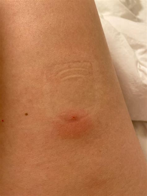 Sitecannula Problems Romnipod