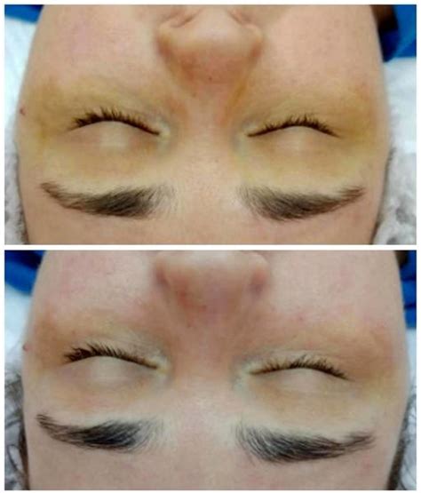 Thermage Cpt Before And After Photos Facelift Info Prices Photos Reviews Q A