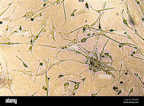 Glioblastoma Cell Culture Human Glioma Cells Under Magnification Stock