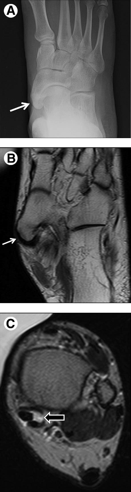 Cornuate Navicular A B Radiograph And Axial Pd Fse Sequence Show